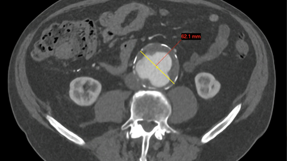 Abdominal Aortic Aneurysm (AAA) Screening - Liverpool Vascular Clinic
